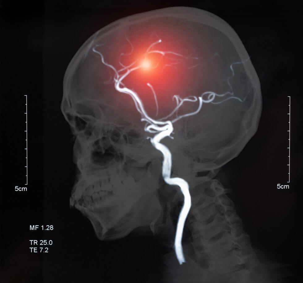Stem Cell Therapy Offers Hope for Brain Recovery After Stroke